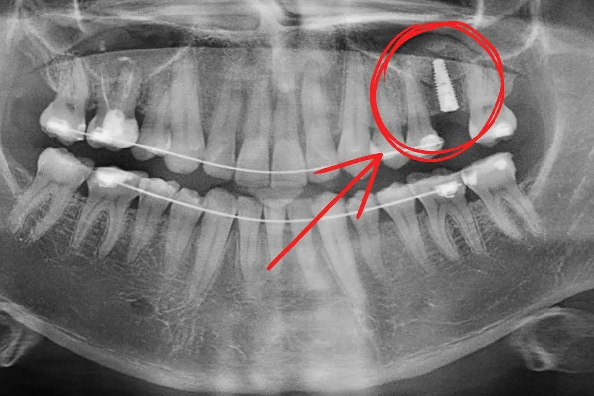 Cum am scăpat de "întunericul din gură" - implant dentar cu adiție de ...